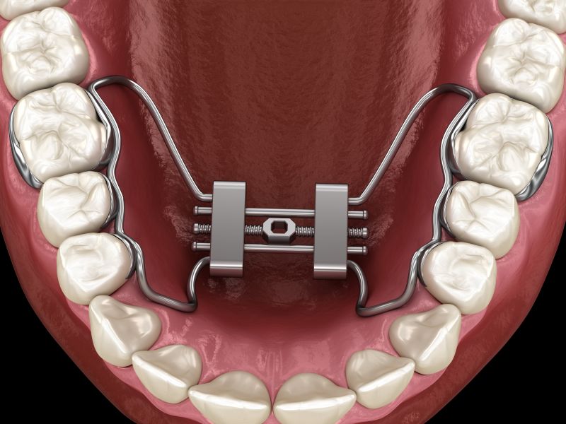 Palatal Expanders 101: What You Should Know About This Treatment